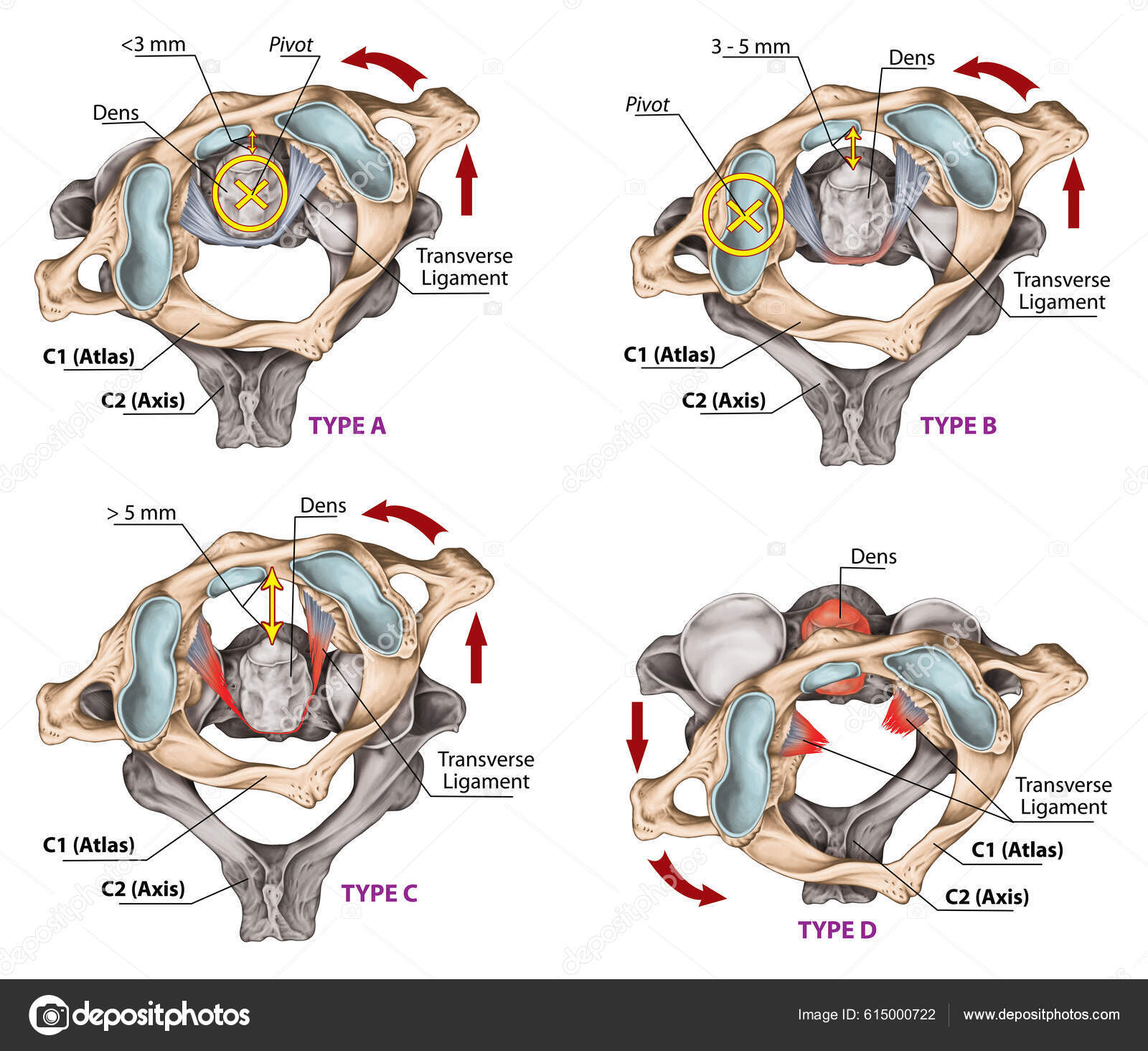 Spostamento Rotatorio Traumatico Dell'atlante Sublussazione Lussazione ...