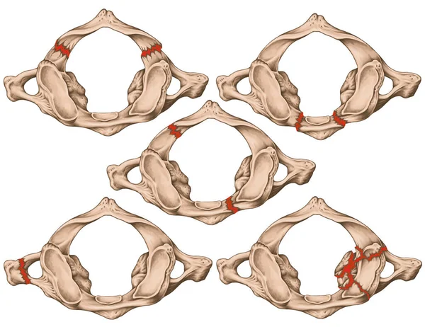 Jefferson Fracture Classification