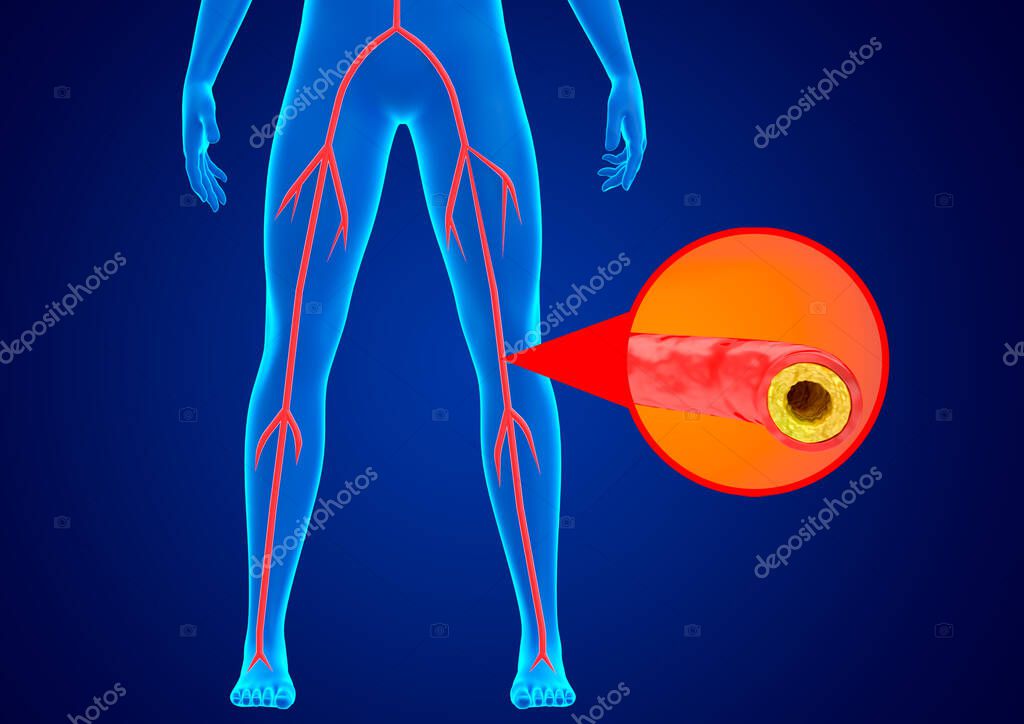 La enfermedad arterial periférica es la acumulación de grasa y calcio ...