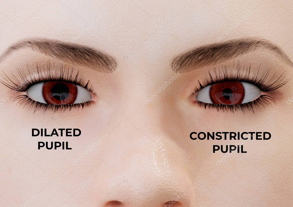 La miosis es una afección en la que una o ambas pupilas se contraen ...