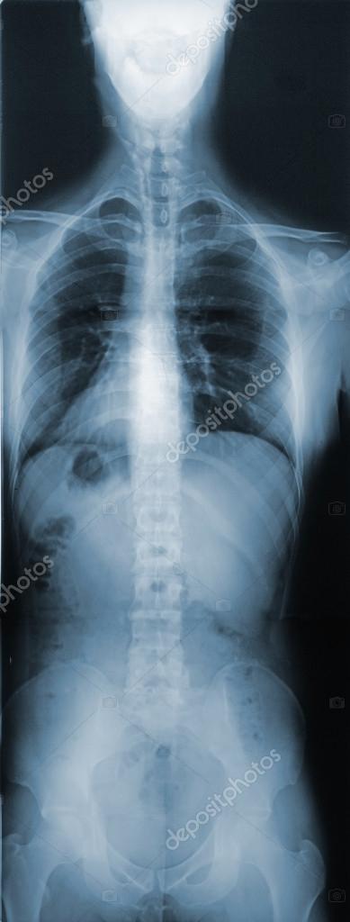 X-Ray of the Torso Stock Photo by ©jamesgroup 13457738