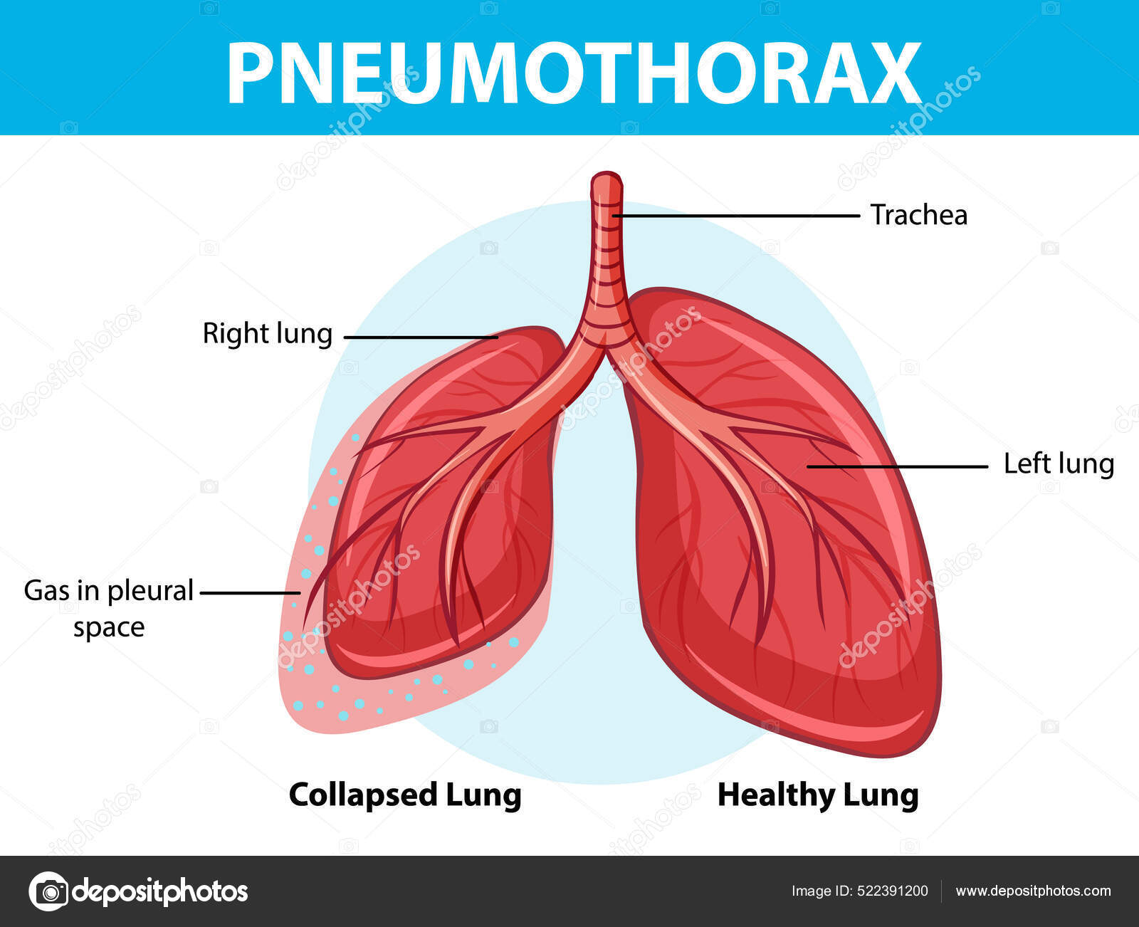 Diagrama De Pulmoes Spanish HIE Multimedia Broncoscopio
