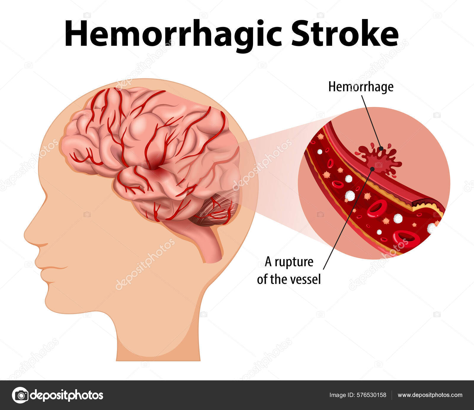 Human Hemorrhagic Stroke Illustration Stock Vector by ©blueringmedia 576530158