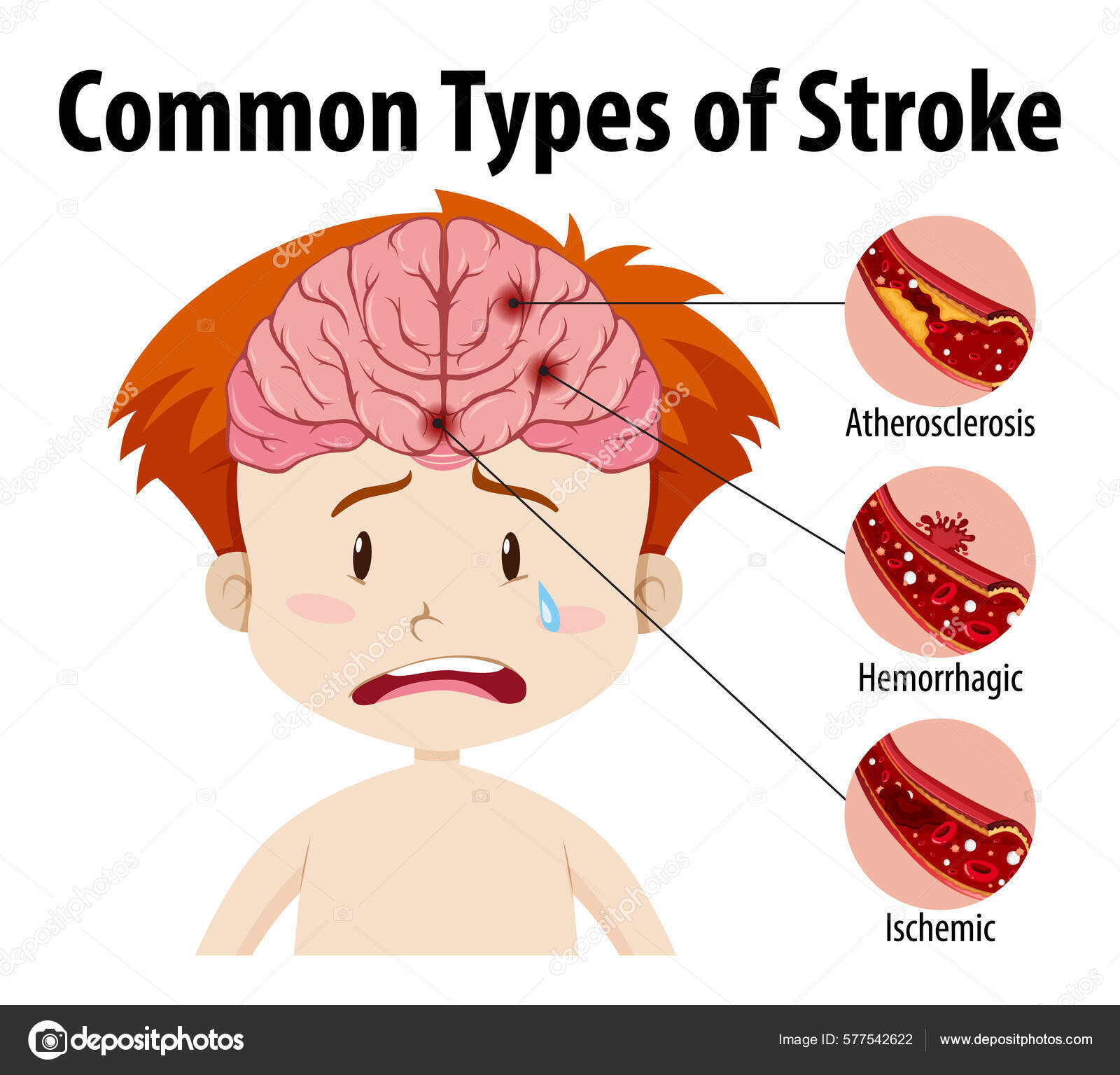 Human Common Types Stroke Illustration Stock Illustration by ... Human Common Types Stroke Illustration Stock Illustration by ...