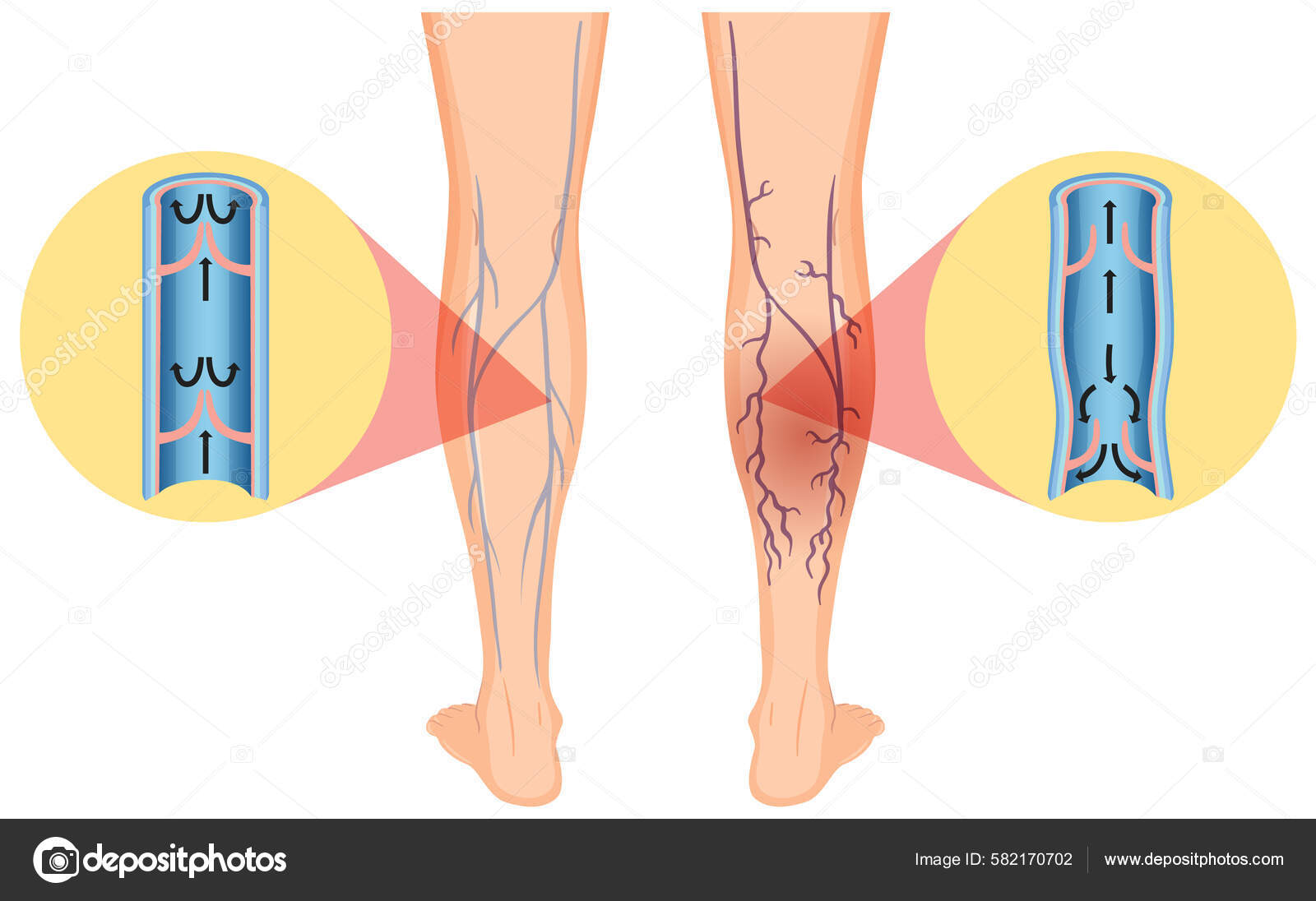 Kaki Manusia Dengan Gambar Vena Varicose Vektor Stok oleh ...