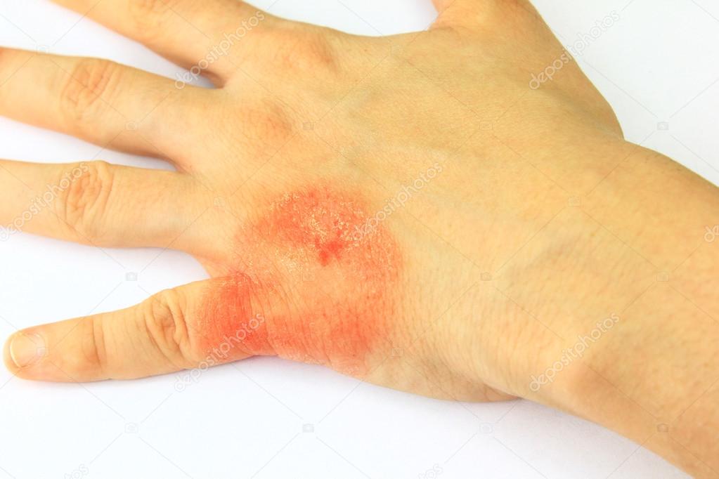 Skin disease — Stock Photo © darkhriss #32926499