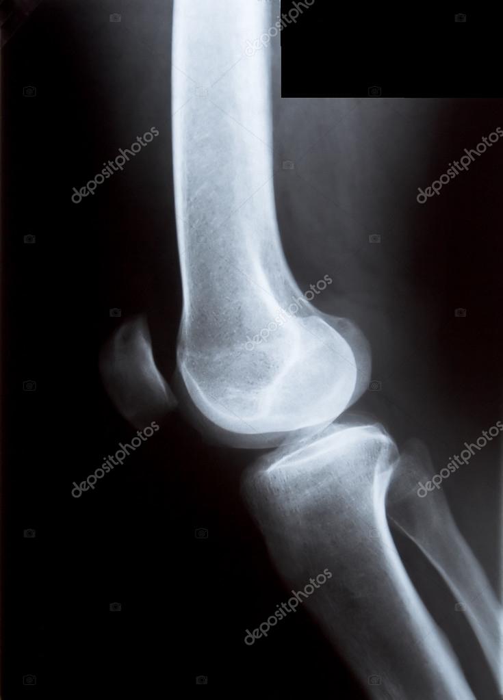 X-ray of the knee, femur and tibia — Stock Photo © Lusoimages #13302300