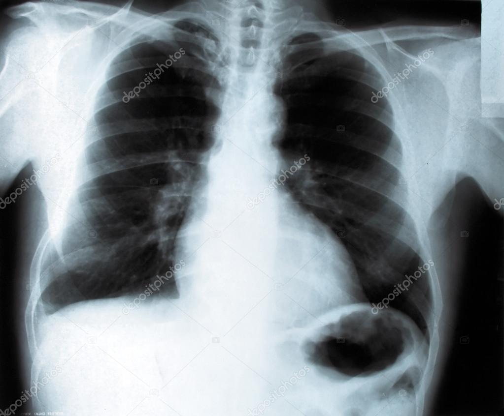 Thorax x-ray of a smoker man — Stock Photo © Lusoimages #13302351