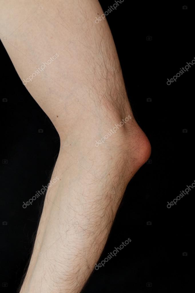 Bursitis de Olecranon también conocida como codo de los estudiantes ...