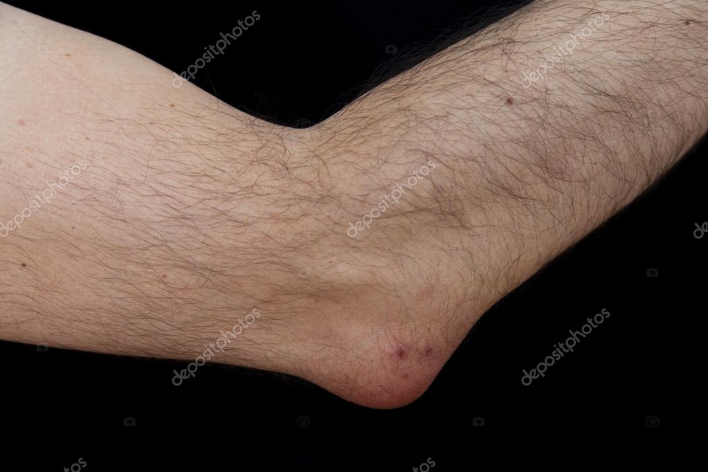 Bursitis de Olecranon también conocida como codo de los estudiantes ...