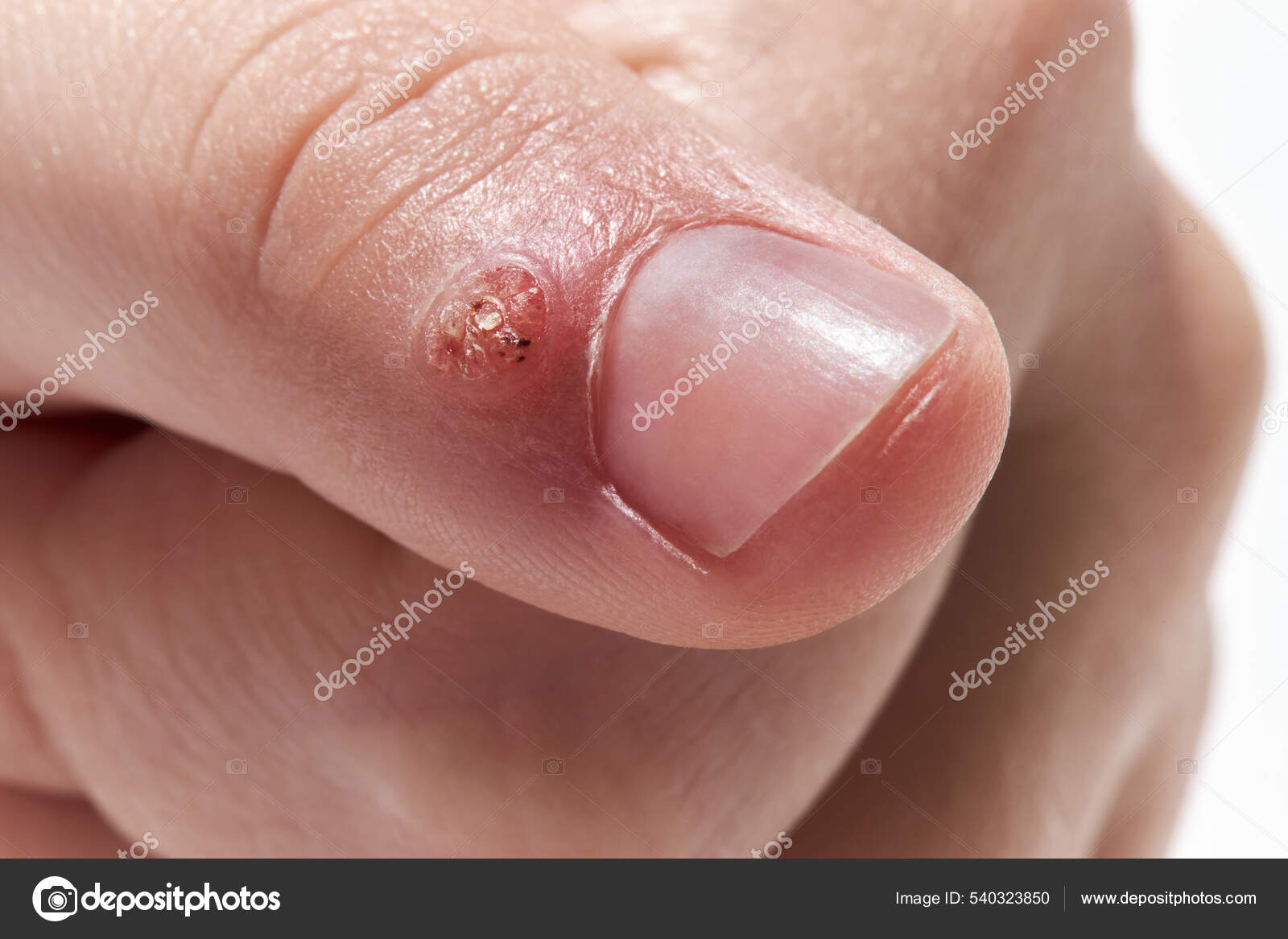 What Does A Wart Look Like On Fingers In Indonesia - Infoupdate.org