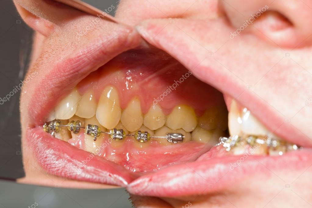 Dental braces on teeth - orthodontic treatment — Stock Photo ...