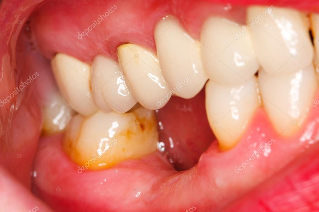 Una fotografía macro tomada de los molares superiores e inferiores y ...