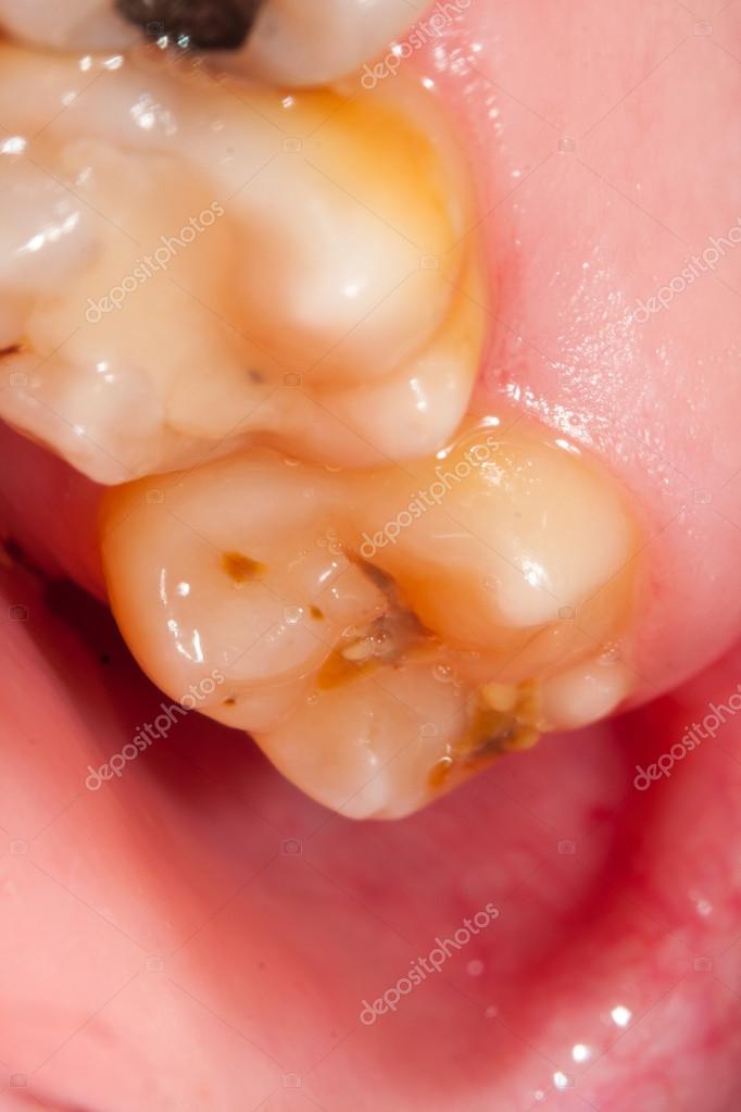 Dental problems — Stock Photo © Lighthunter #14038671