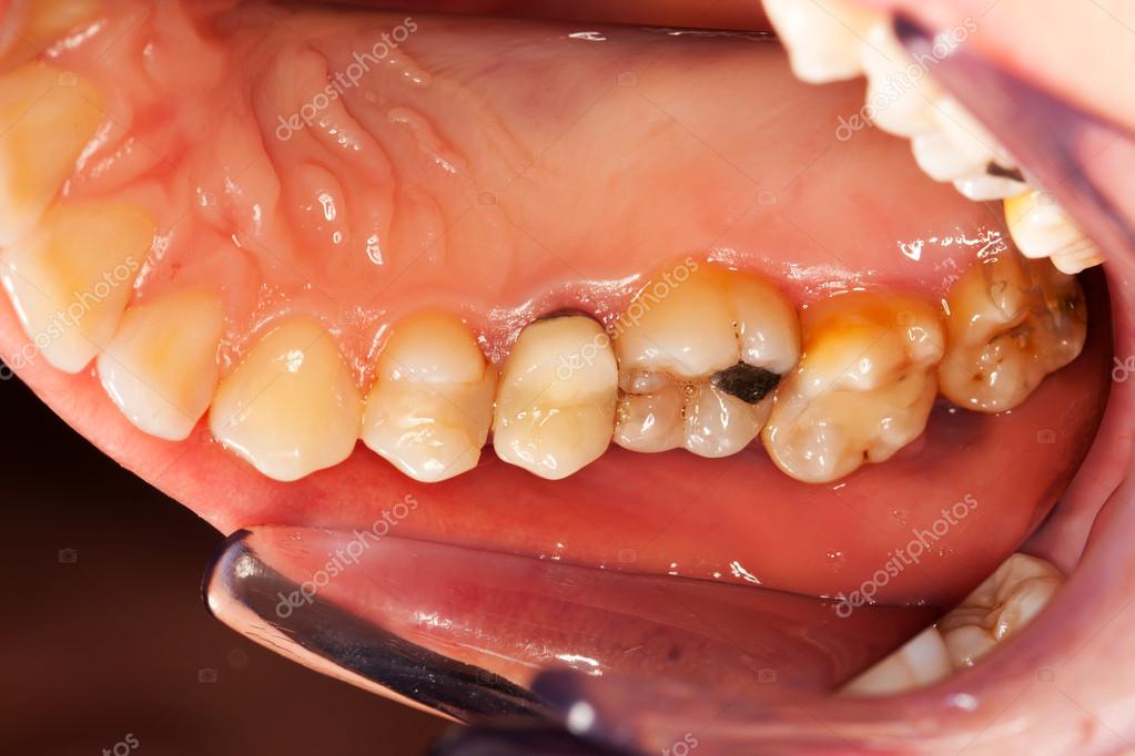 Dental problems — Stock Photo © Lighthunter #14039124