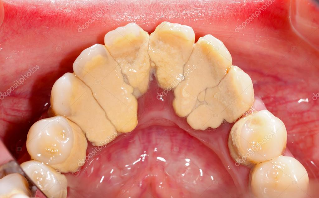 Tartar — Stock Photo © Lighthunter #24849145