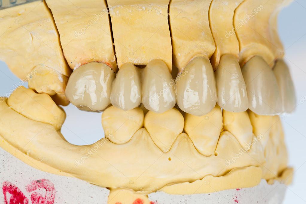 Porcelain teeth - dental bridge Stock Photo by ©Lighthunter 29224743