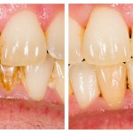 Before and after removal of tartar — Stock Photo © DrTrIg #34095251