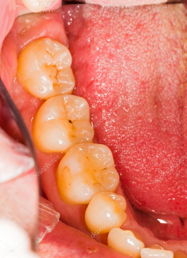 Molar Teeth — Stock Photo © Lighthunter #40718615