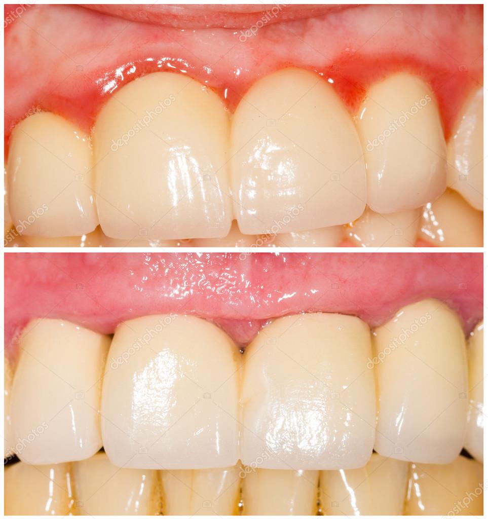 Buffing Teeth Tangent and with Shoulder — Stock Photo © Lighthunter ...