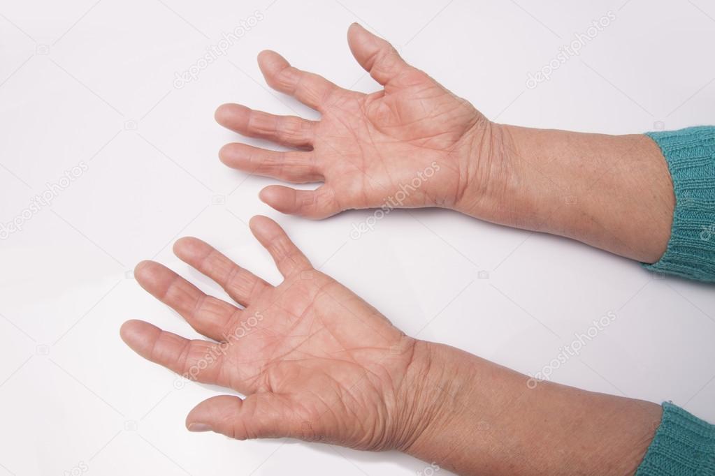 Manos con artritis reumatoide 2023