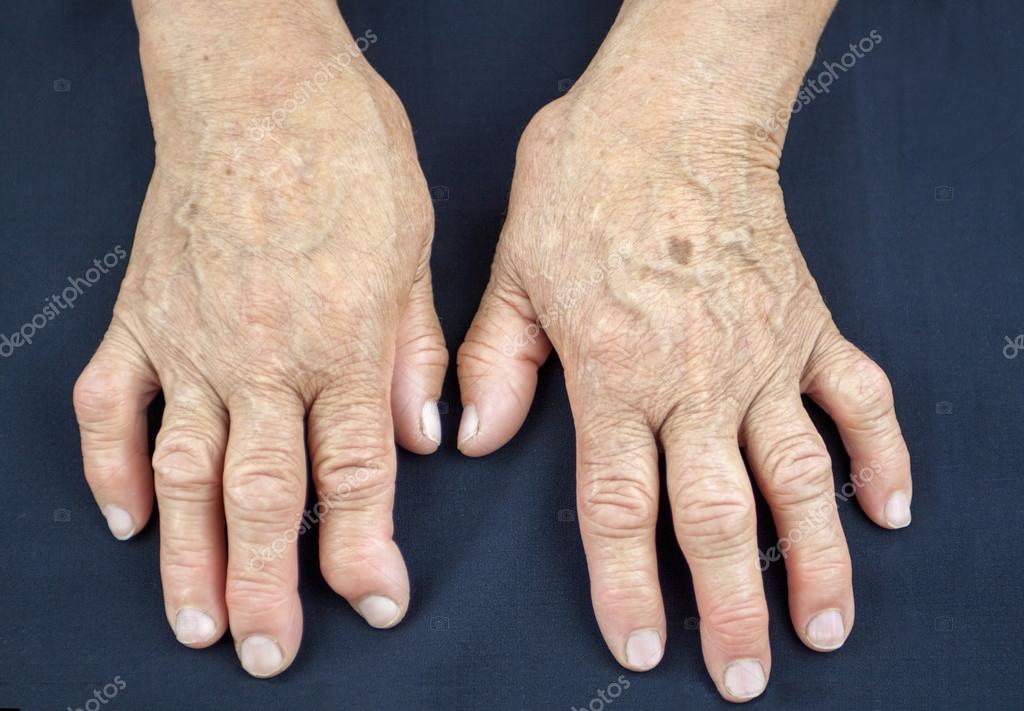 Las manos de la mujer deformada de la artritis reumatoide — Foto de ...