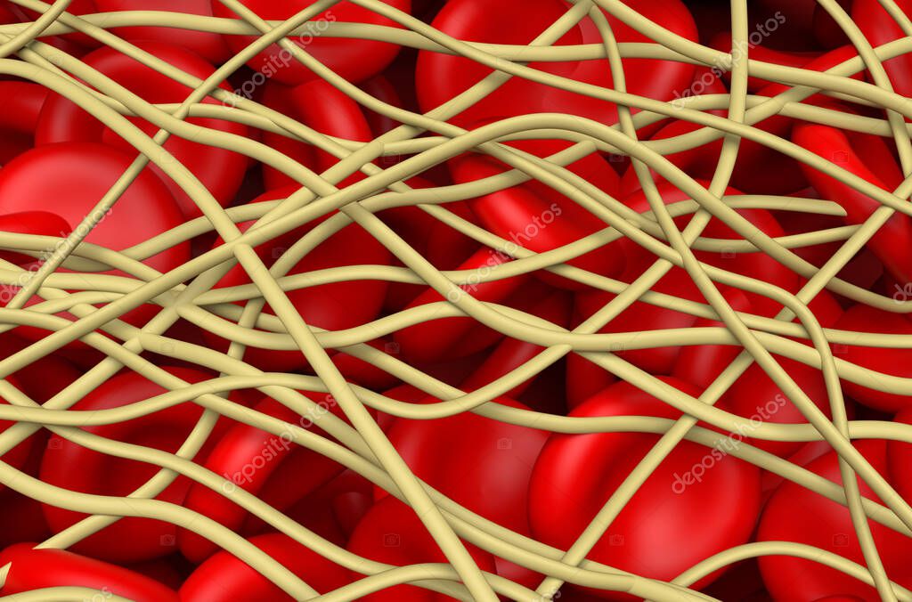 Blood clot. The red blood cells are trapped in filaments of fibrin ...