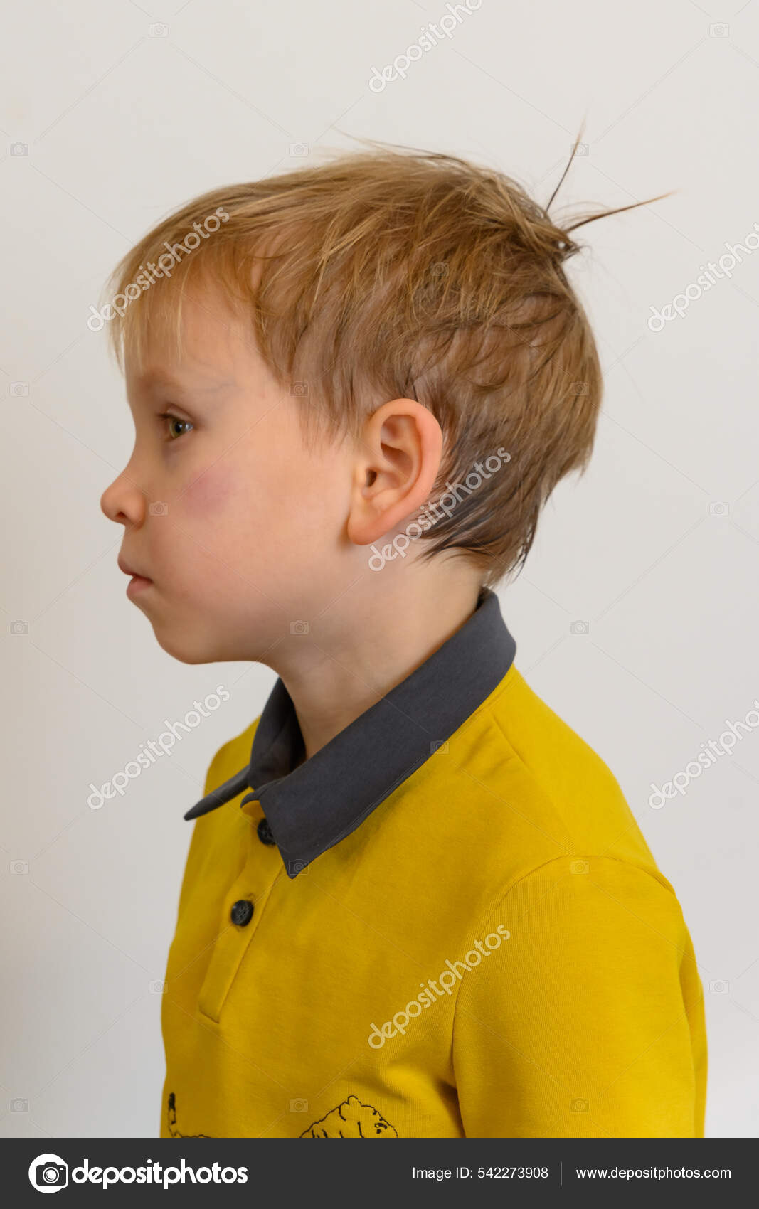 Injury Boy's Head Falling Collision Hematoma Eye Child Standing ...