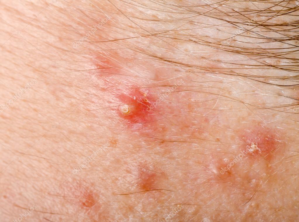 Pimple on human skin macro — Stock Photo © obencem #18607053