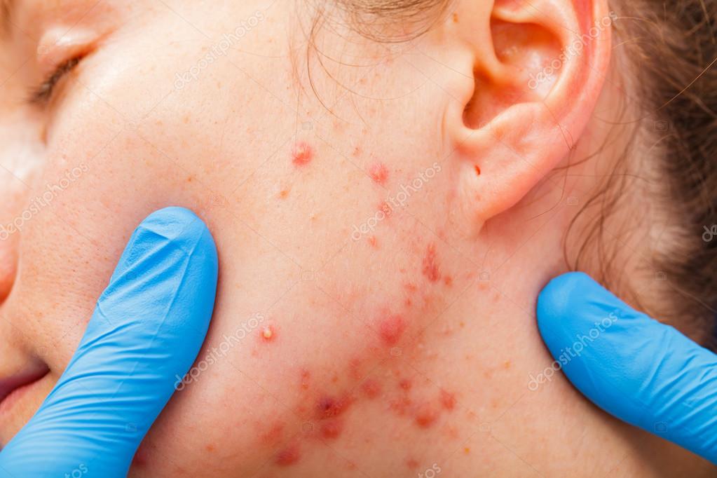 Acne skin — Stock Photo © obencem #40629935