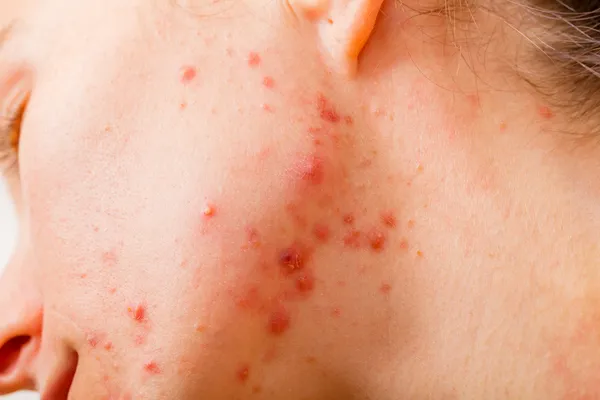 Human skinwith acne Stock Photo by ©obencem 18607059