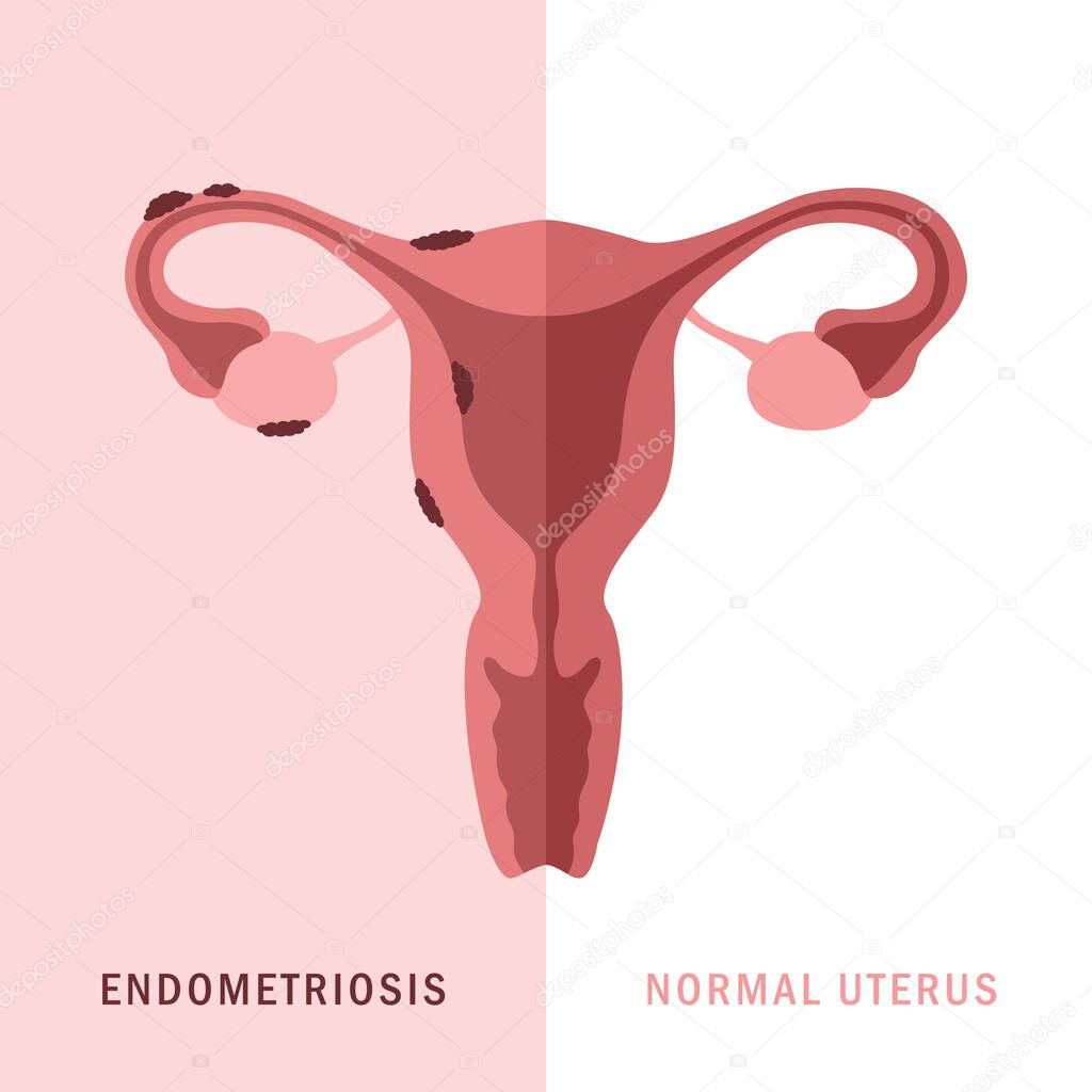 endometriosis y útero normal mujer anatomía de la salud info graphic 2023