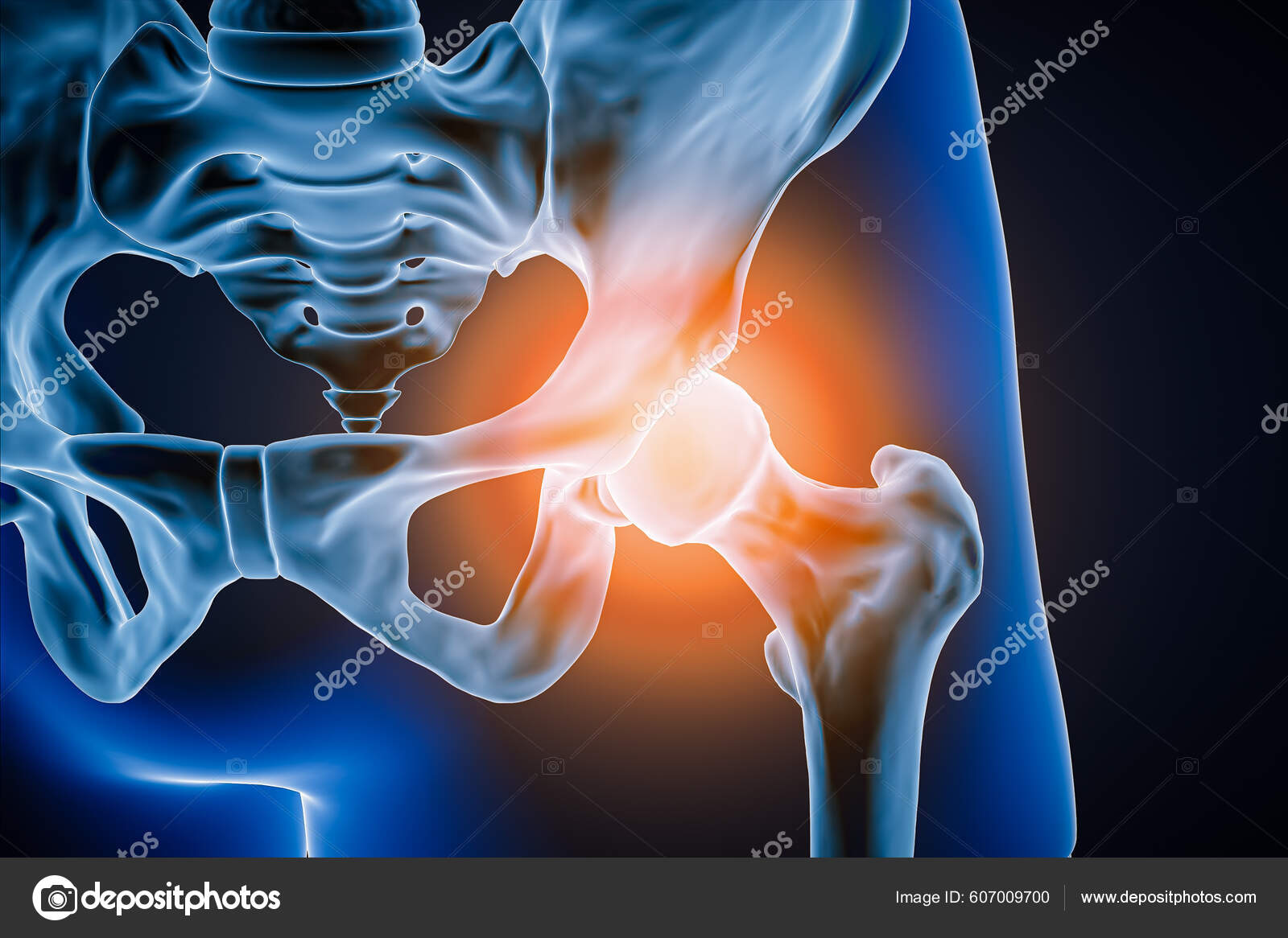 Anterior Front View Human Hip Joint Bones Inflammation Injury Rendering ...