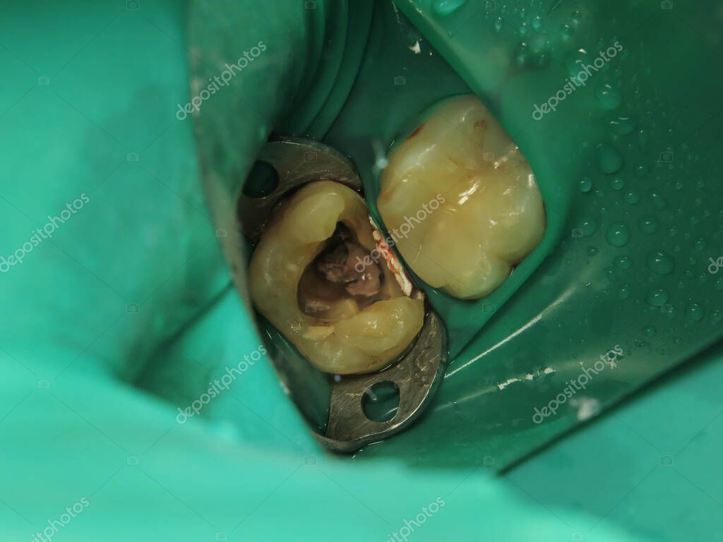 tratamiento de un diente con un orificio en el dentista. una caries ...