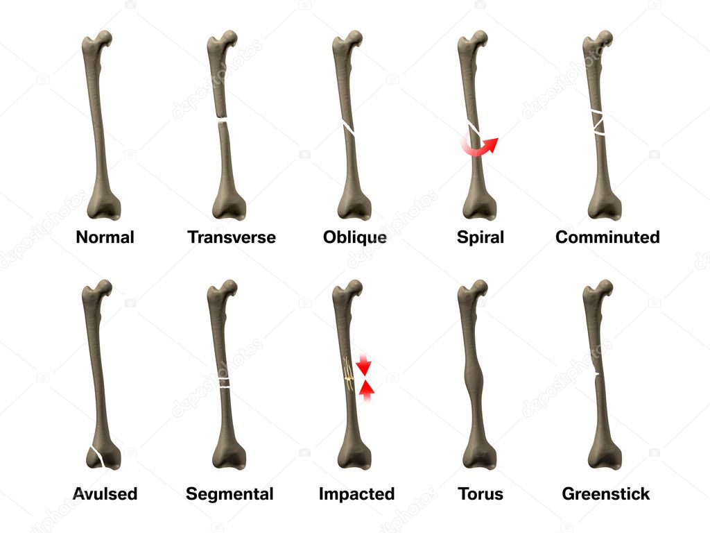 All Types of Bone Fractures — Stock Photo © decade3d #22971884 All Types of Bone Fractures — Stock Photo © decade3d #22971884