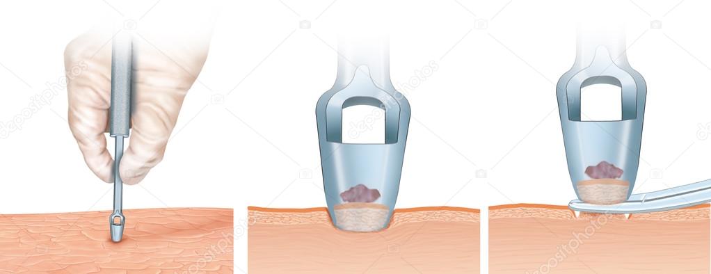 Puncture skin biopsy Stock Photo by ©Alexilus 21672903
