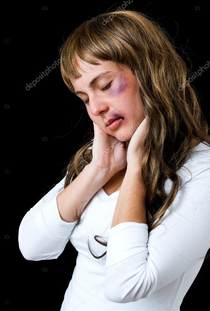 Woman with bruises Stock Photo by ©bertys30 33221449