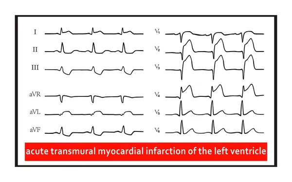Inferior myocardial infarction Stock Photos, Royalty Free Inferior ...