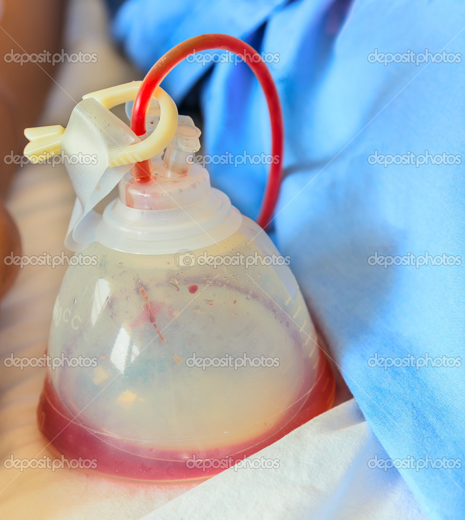 Drenaje de succión sangre del paciente a jackson-pratt — Foto de Stock ...