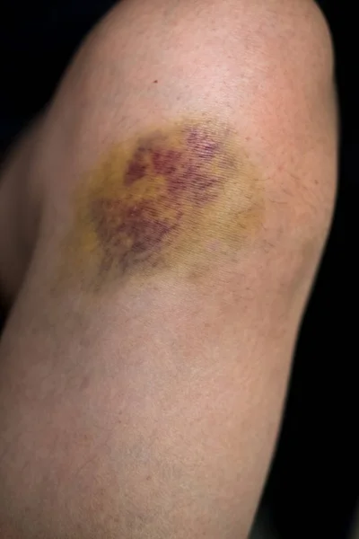 Ice on bruise Stock Photos, Royalty Free Ice on bruise Images ...