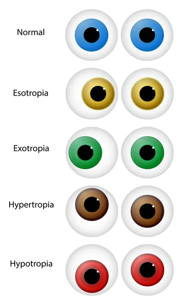 Exotropia Vector Art Stock Images | Depositphotos
