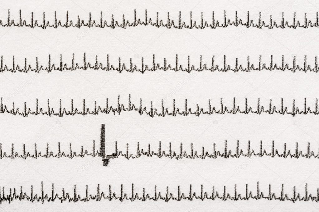 Extrasystole On Ecg — Stock Photo © radub85 #42281639