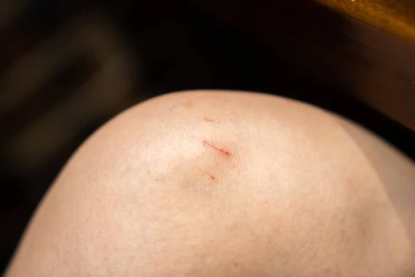 Picaduras de pulgas Stock Photos, Royalty Free Picaduras de pulgas ...