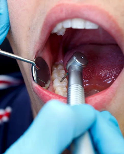 Dental drilling Stock Photo by ©ocskaymark 23504691