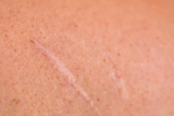 Cicatriz atrófica Fotos de Stock, Cicatriz atrófica Imagens sem ...