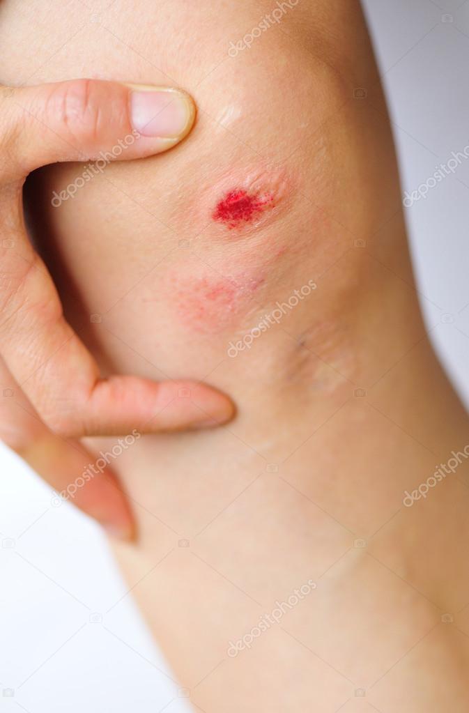 Injured knee Stock Photo by ©lzf 44240017
