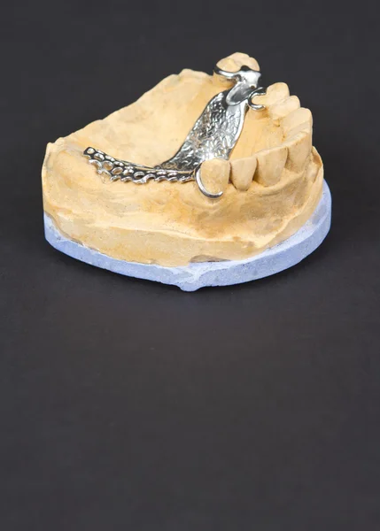 Metal framework of a partial prothesis — Stock Photo © giorgiomtb #22803664