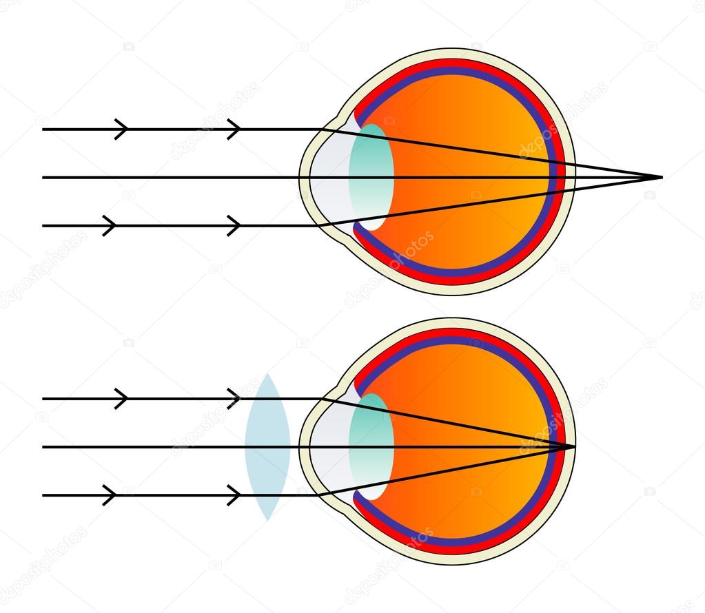 Illustration of hyperopic eye with comparison to normal eye Stock Photo ...