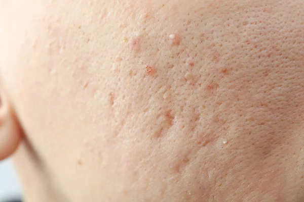 Granos en la piel fotos de stock, imágenes de Granos en la piel sin ...