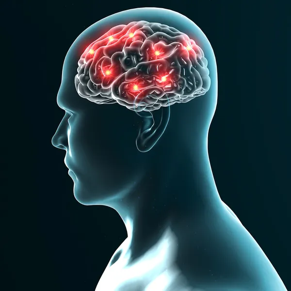 Stroke brain Stock Photos, Royalty Free Stroke brain Images | Depositphotos